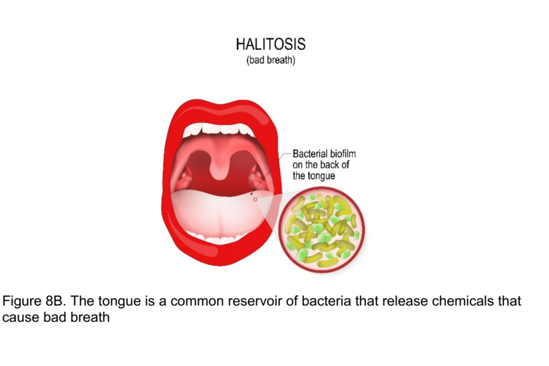 Gum Diseases and Halitosis