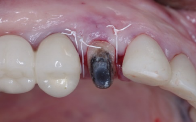 Crown Lengthening Surgeries