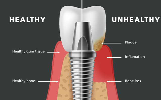 Peri-implant Diseases