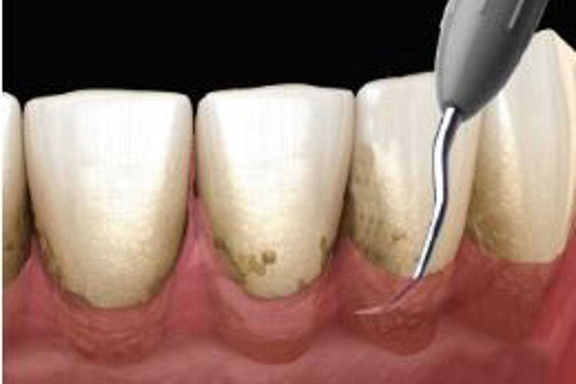 Management of Gum Diseases