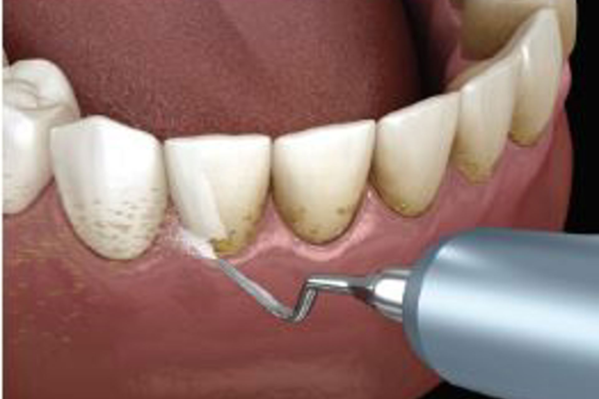 Management of Gum Diseases
