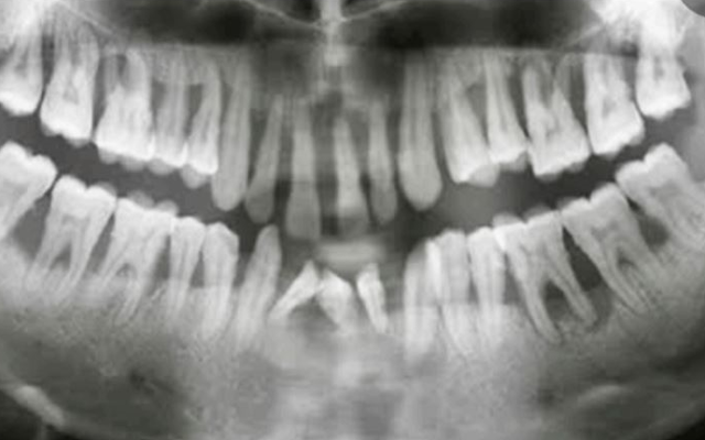 Dental Radiographs for your Periodontal and Implant Care