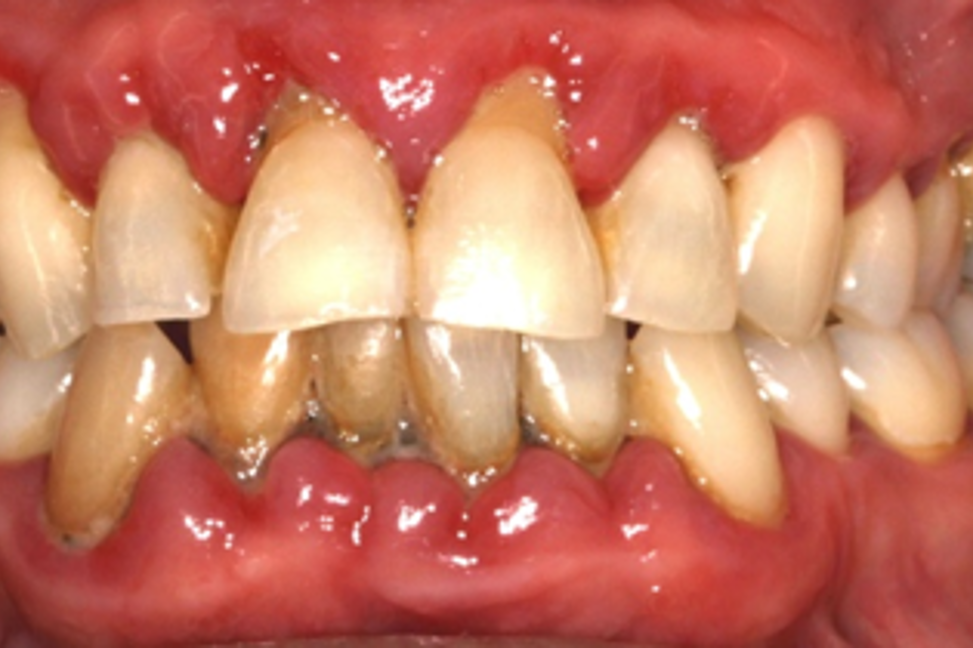 Gum Diseases and Systemic Inflamation - A Healthy Mouth For a Healthy Body